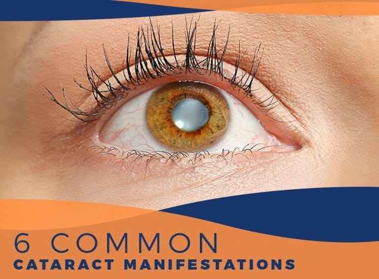 6 Common Cataract Manifestations 6 Common Cataract Manifestations